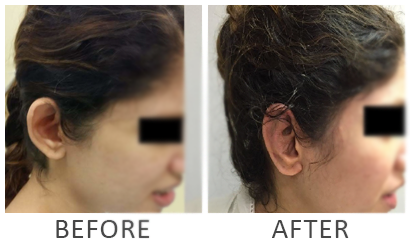 Otoplasty in Karachi - Reshape Your Ears with Expert Surgery